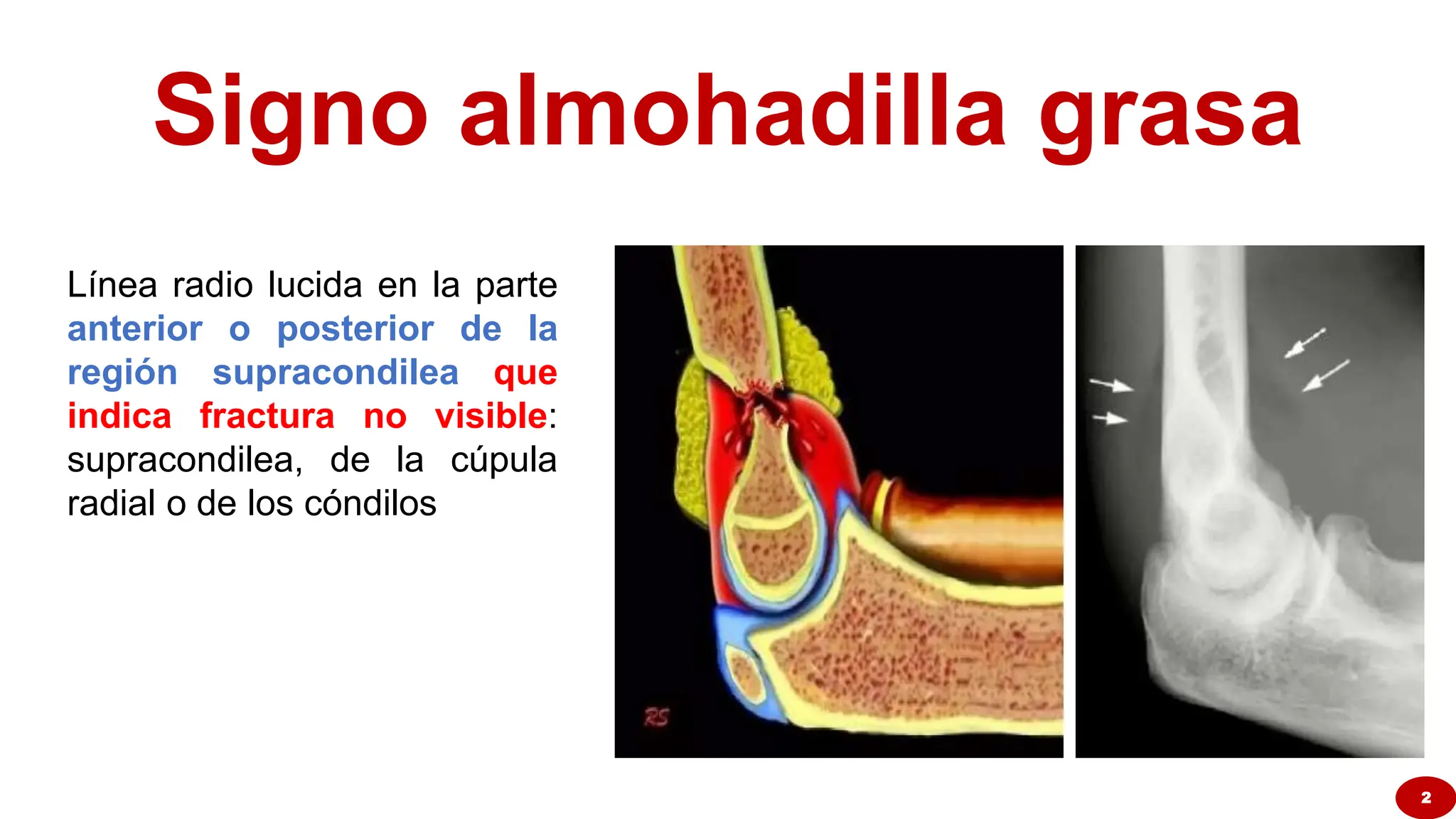 epífisis distal de humero distal revicion.ppt
