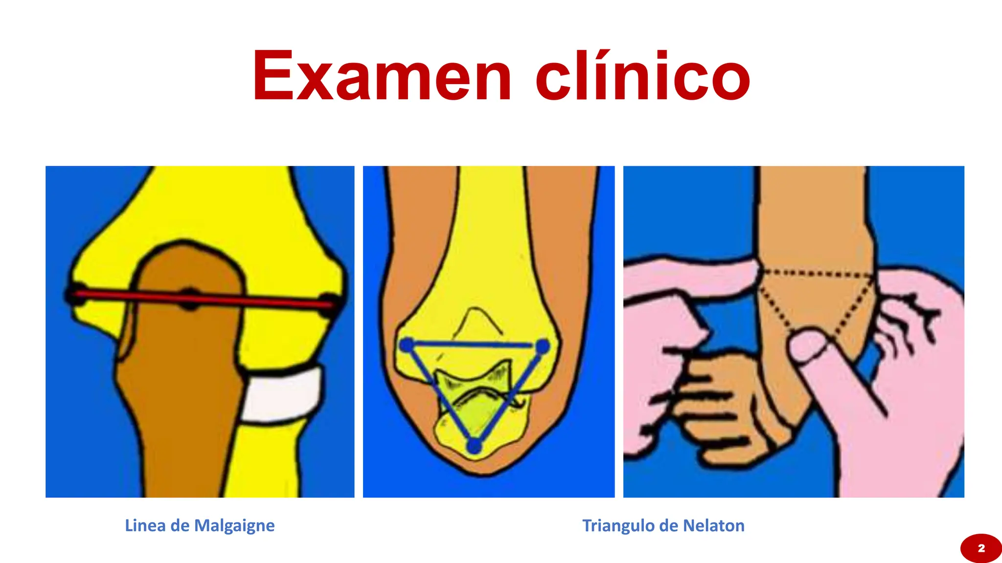 epífisis distal de humero distal revicion.ppt