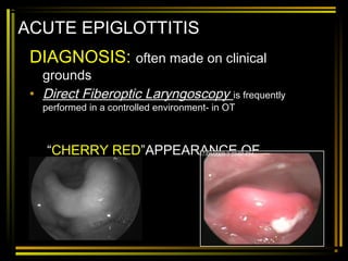 Epiglotitis , ALTB. Final year MBBS Lecture | PPT | Ear, Nose and ...