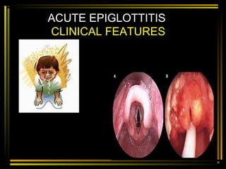 Epiglotitis , ALTB. Final year MBBS Lecture | PPT