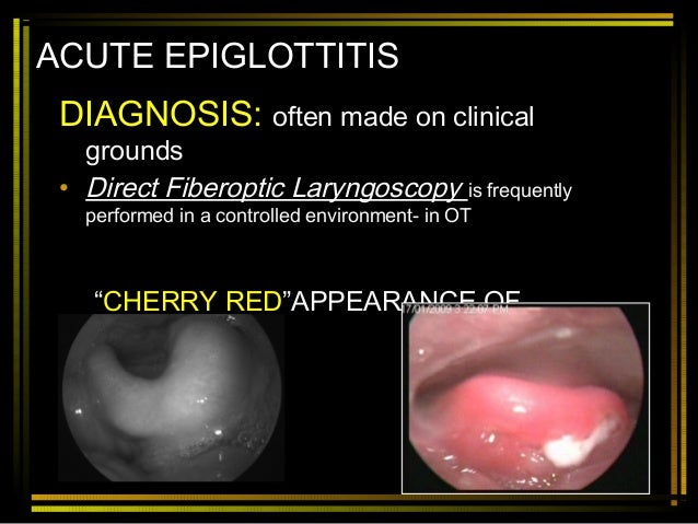 Epiglotitis , ALTB. Final year MBBS Lecture