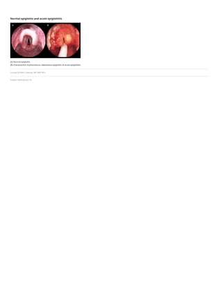 Epiglotitis (supraglotitis) características clínicas y diagnóstico ...