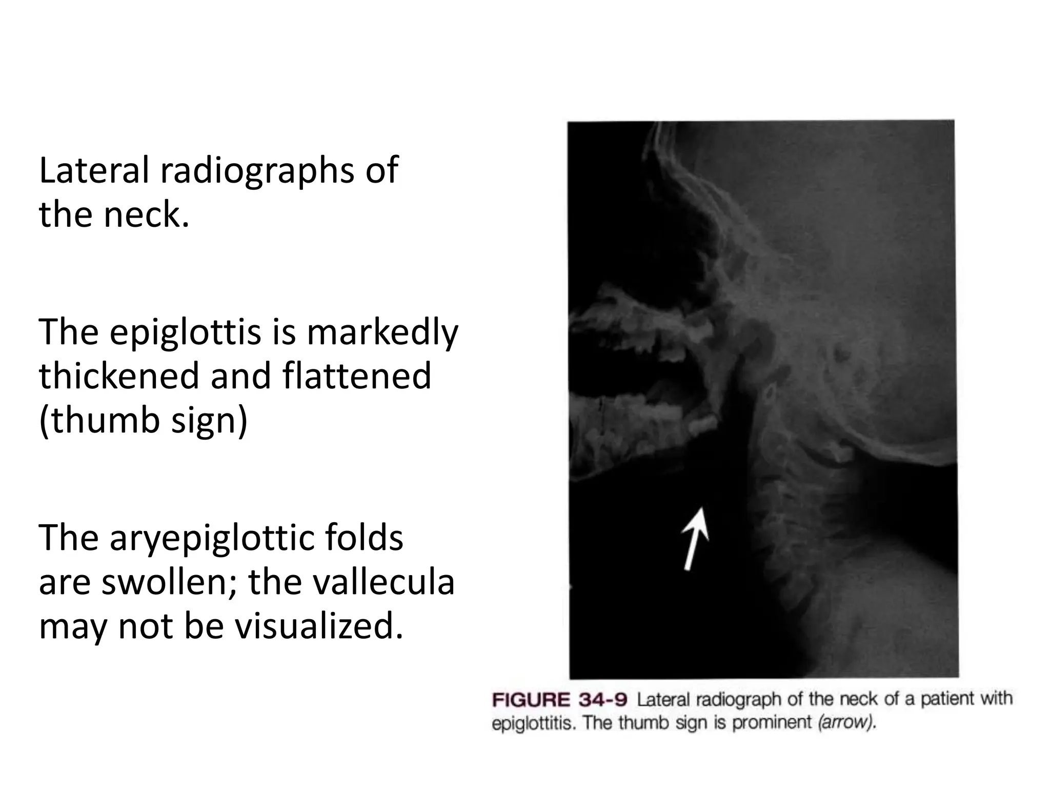 Epiglottis Respiratory Disease-WPS Office.pptx