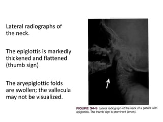 Epiglottis Respiratory Disease-WPS Office.pptx