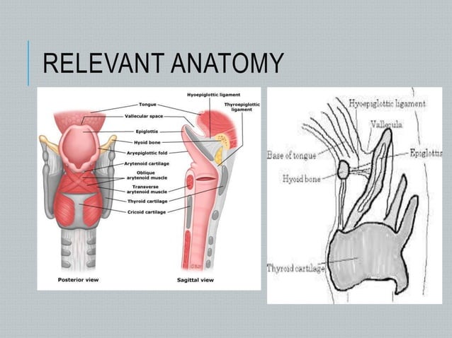 Epiglottitis | PPT