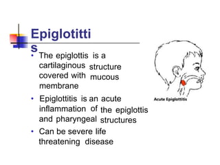 Epiglottitis.pptx