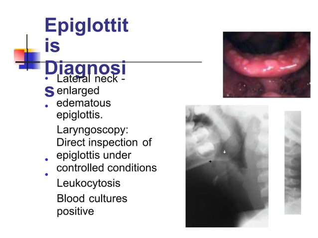 Epiglottitis.pptx | Ear, Nose and Throat Conditions | Diseases and ...