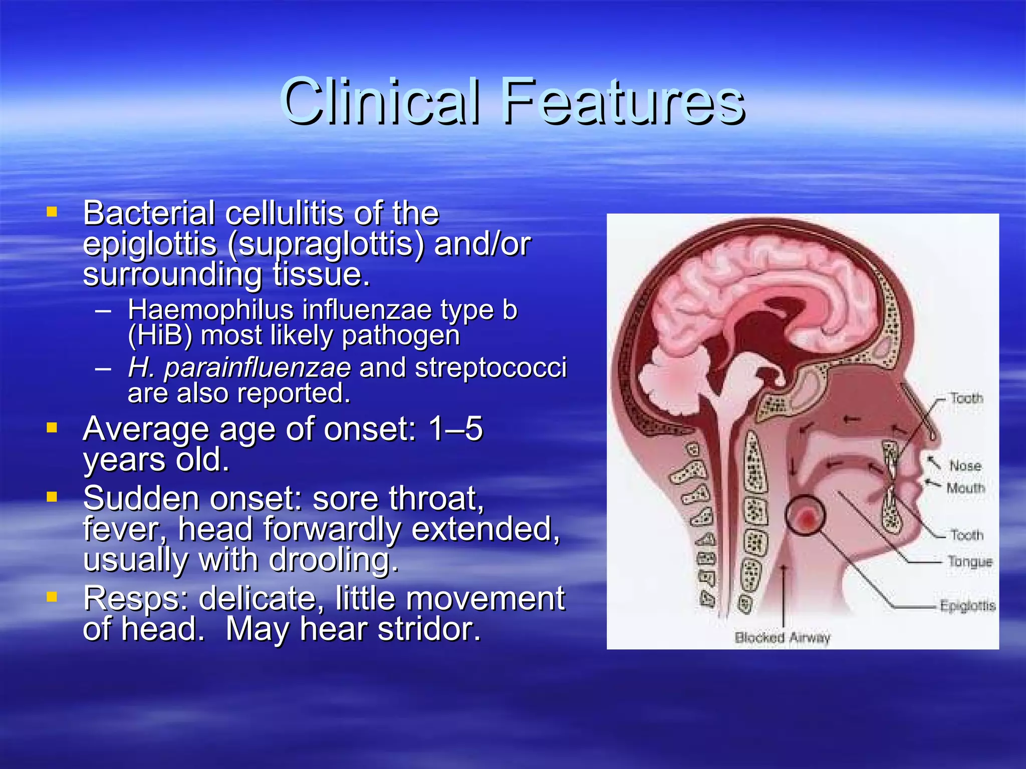 Epiglottitis Mrcme | PPT