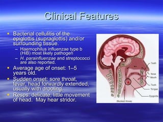 Epiglottitis Mrcme | PPT