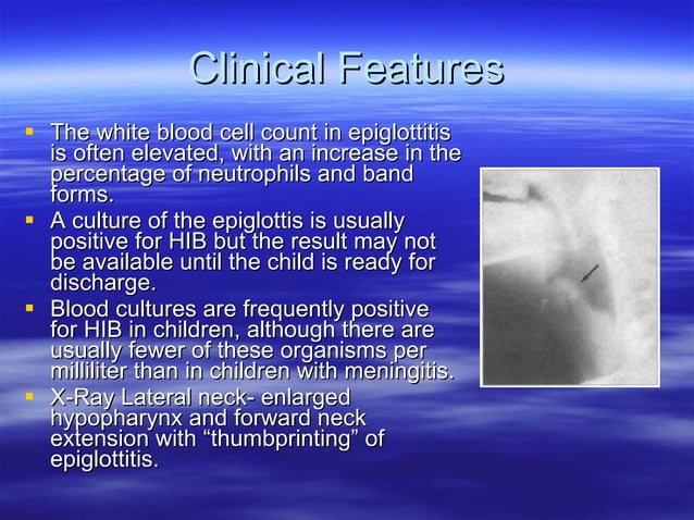 Epiglottitis Mrcme | PPT | Ear, Nose and Throat Conditions | Diseases ...