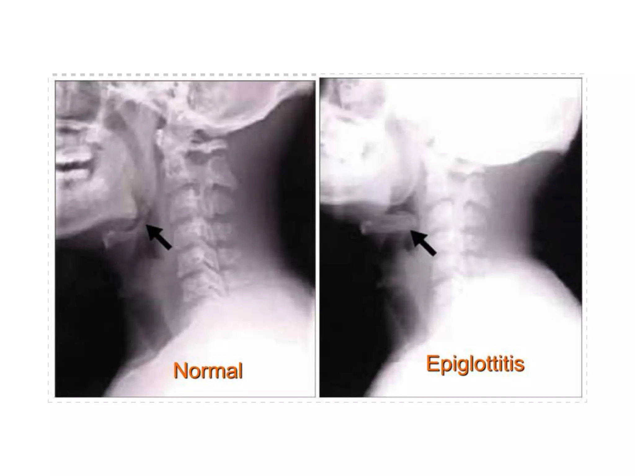 Epiglottitis | PPTX