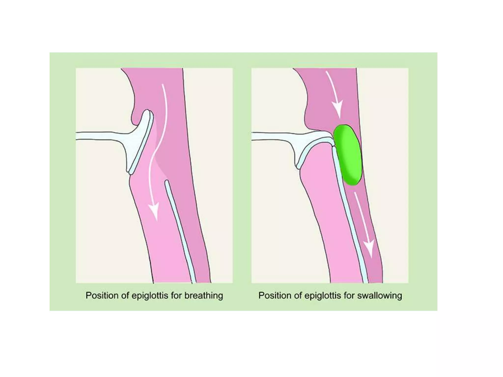 Epiglottitis | PPTX