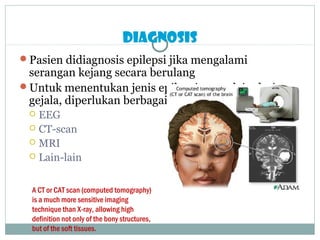 Epilepsi | PPT
