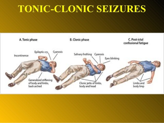 Epilepsi