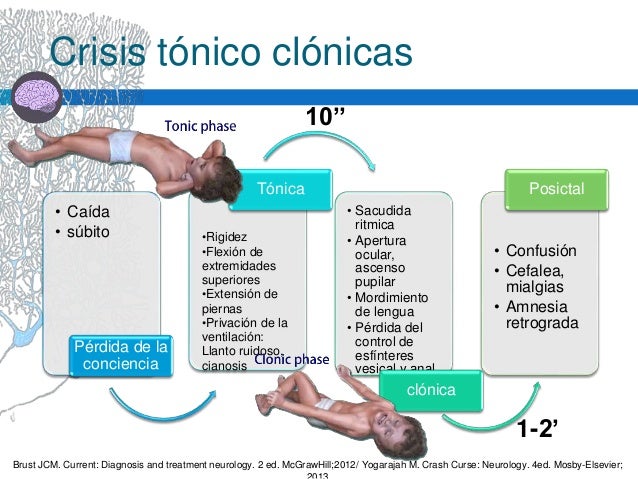 Epilepsia