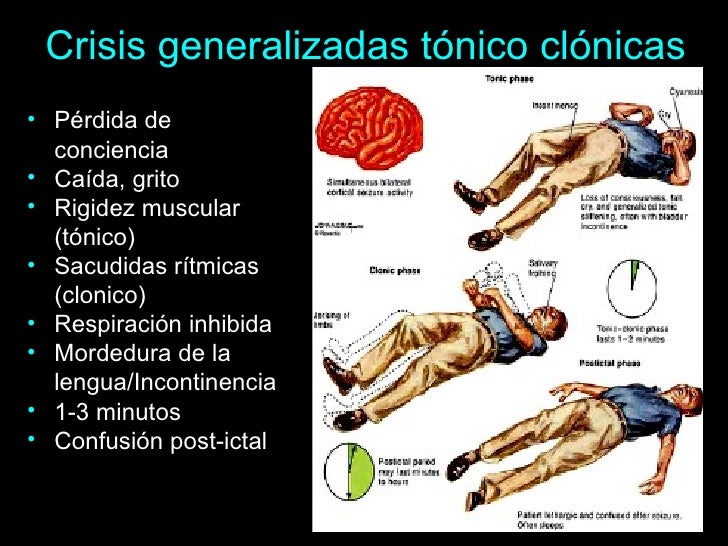 Imagen en epilepsia JLCC