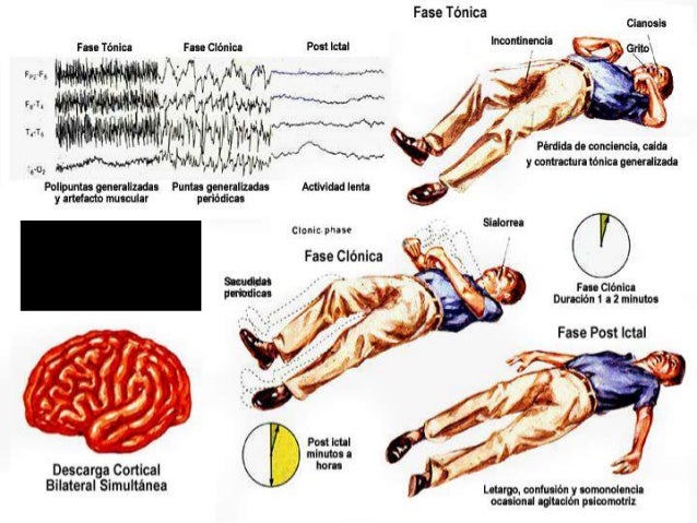 Epilepsia actualizaciones