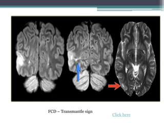Current trends in imaging of Epilepsy | PPTX