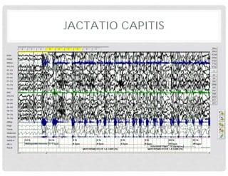 Epilepsia frontal nocturna autosomica | PDF