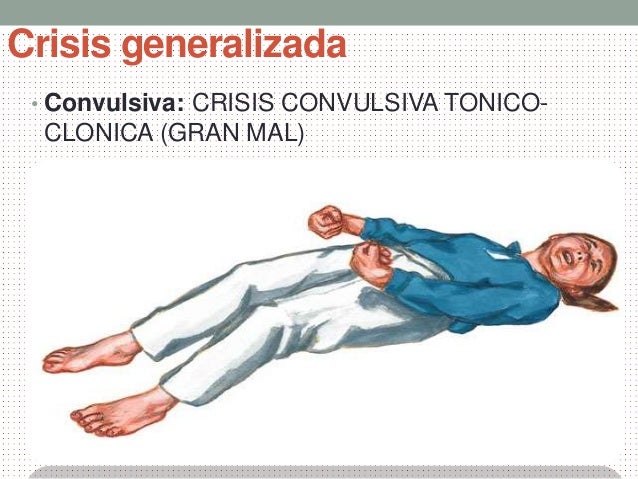Epilepsia generalizada