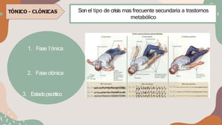 EPILEPSIA NEUROLOGIA.pptx