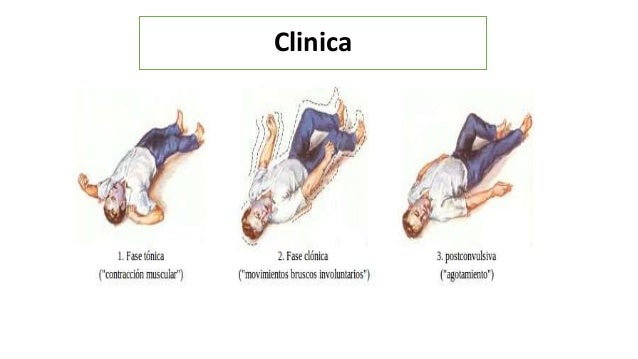Epilepsia y crisis convulsiva