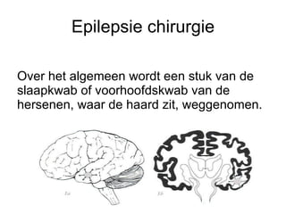 Epilepsie N4 | PPT