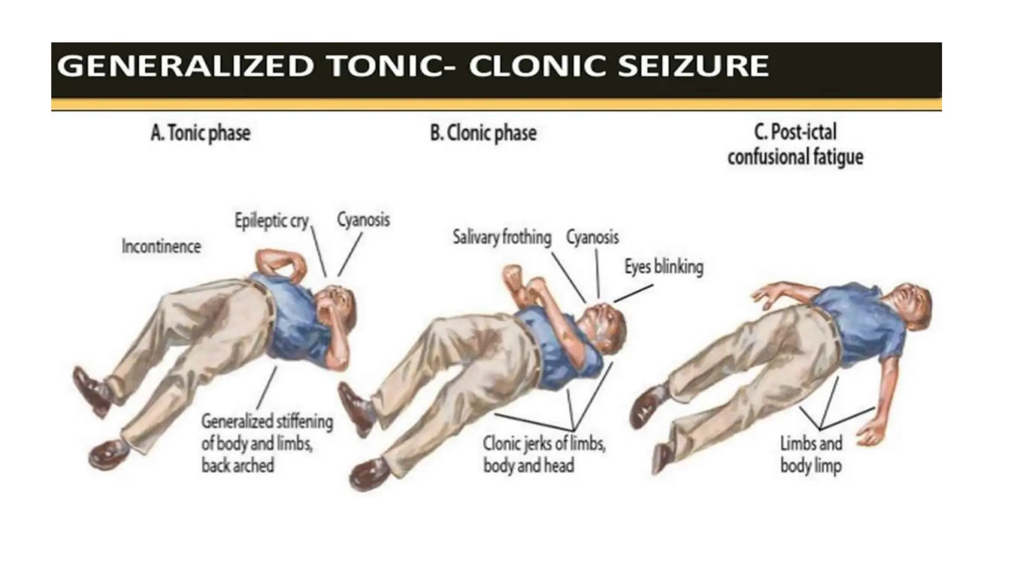 Epilepsi _ status epileptikus.pptx
