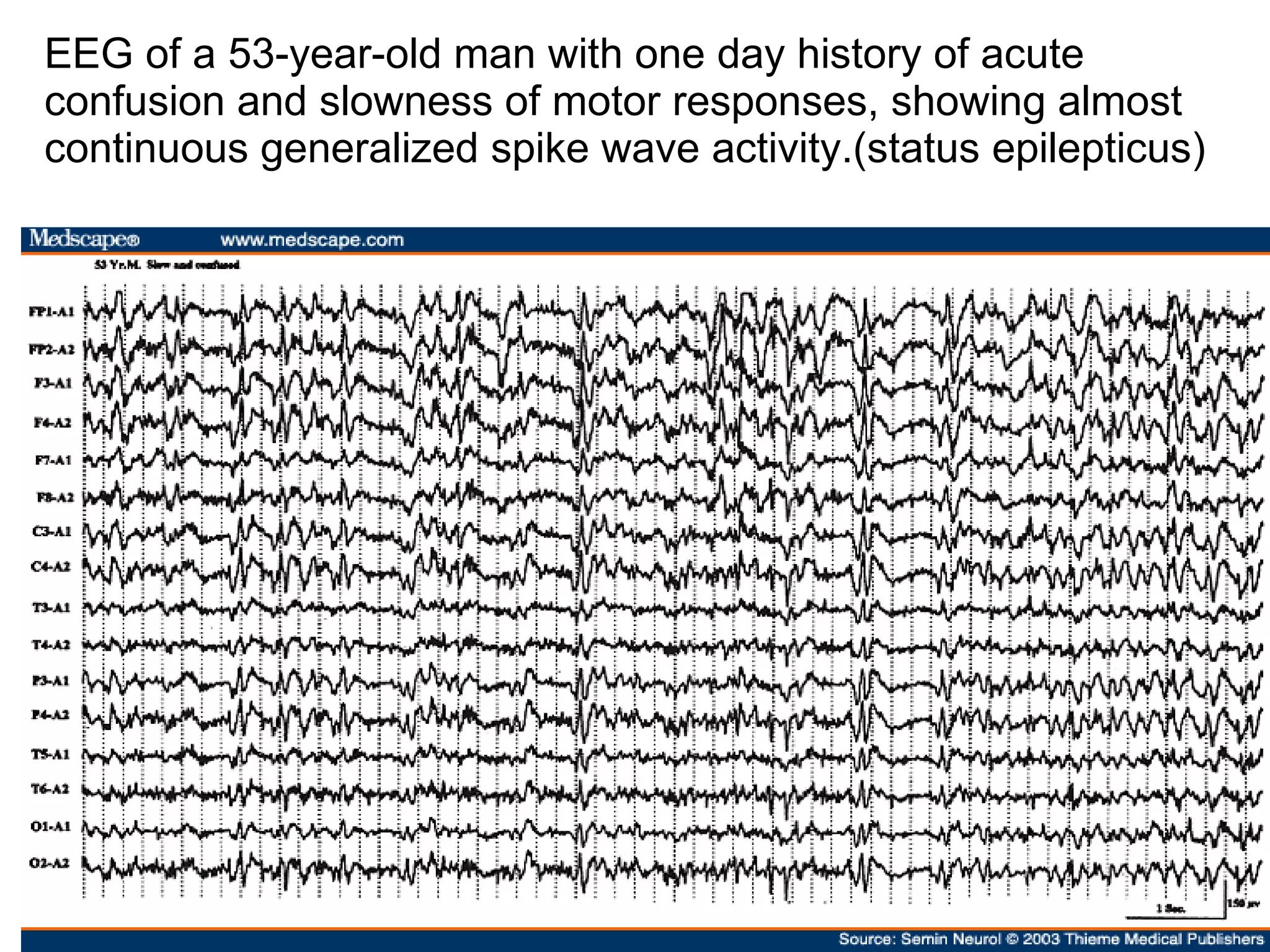 Epilepsy | PPT