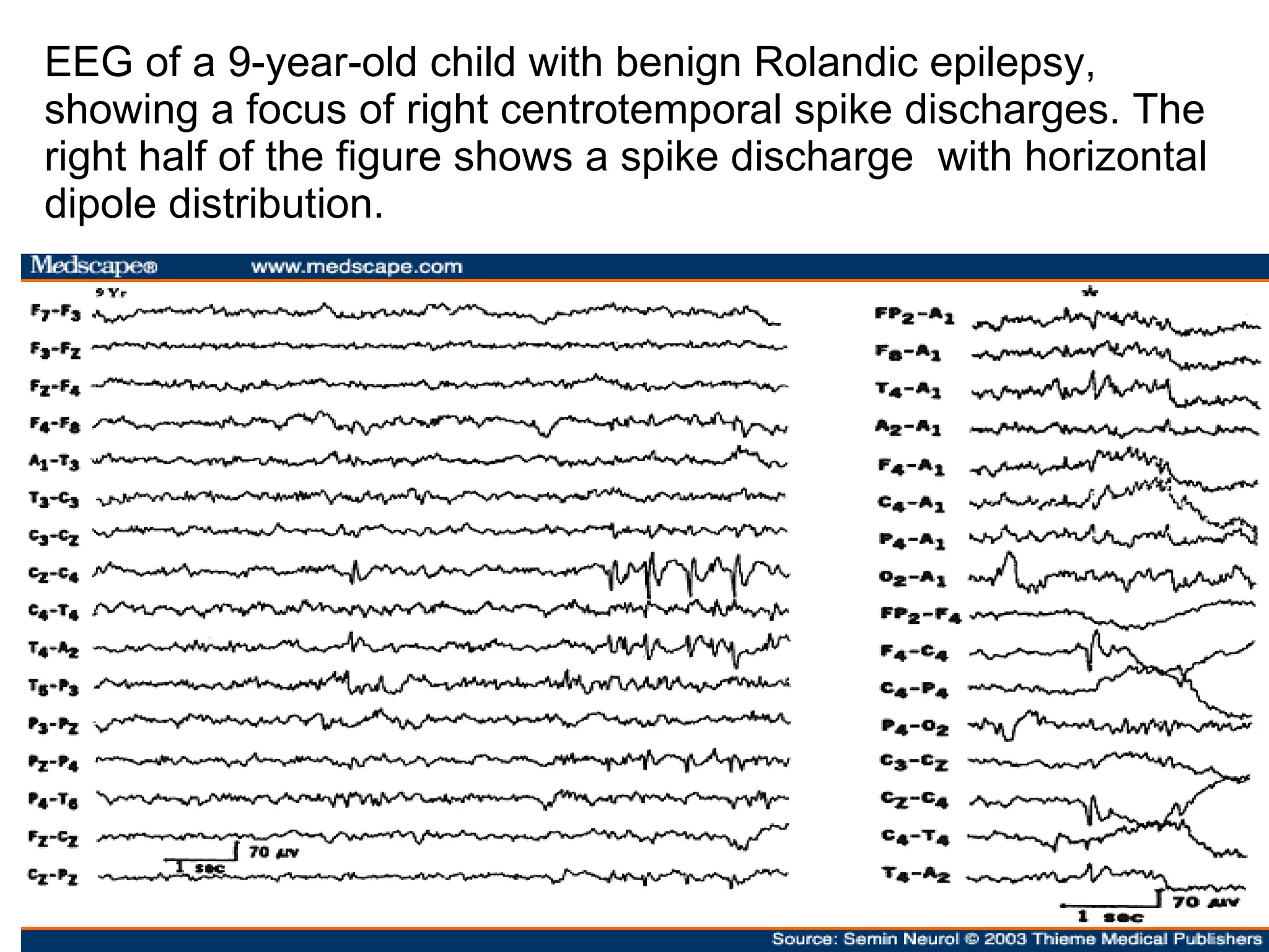 Epilepsy | PPT