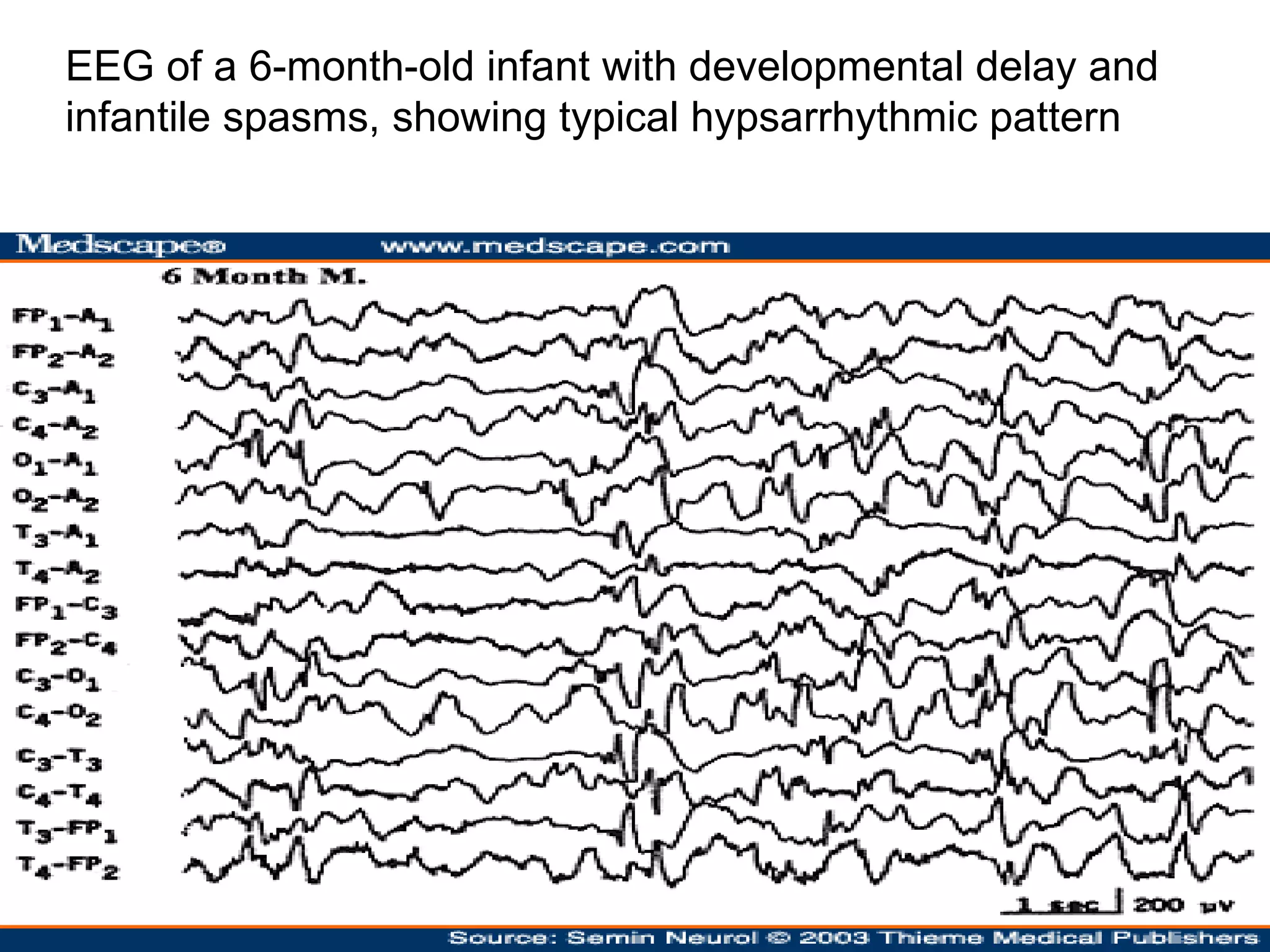 Epilepsy | PPT