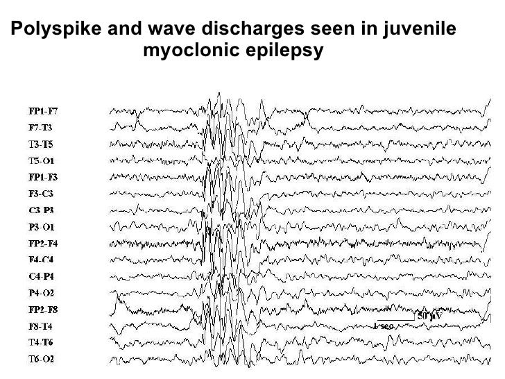 Juvenile Myoclonic Epilepsy Epilepsy Foundation