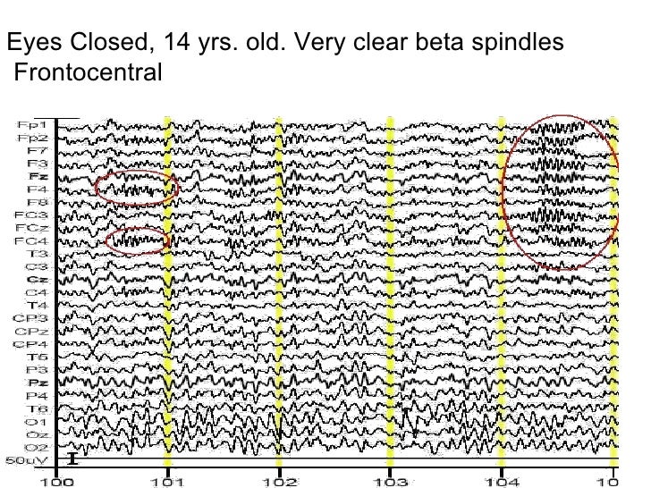 Drug Spindles Eeg at Frank Mcbride blog