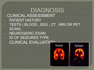 Epilepsy | PPTX | Brain and Nervous System Disorders | Diseases and ...