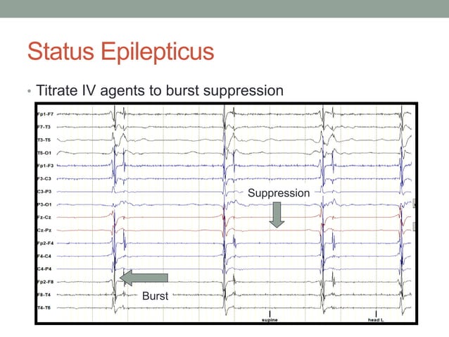 Overview of Epilepsy and types of seizures.ppt