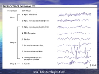 Narcolepsy Brain Waves