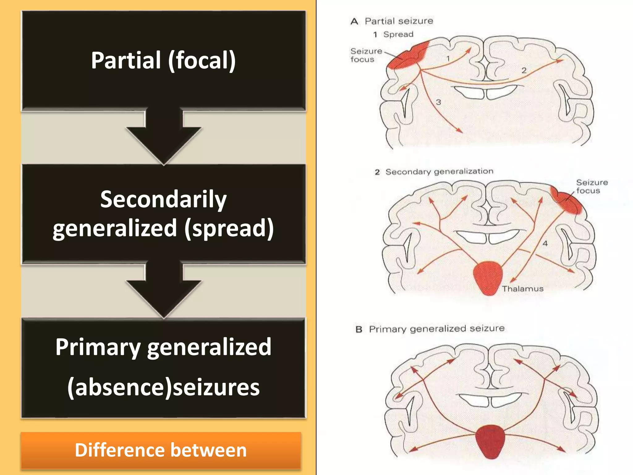 Epilepsy and its management (ppt) | PPTX
