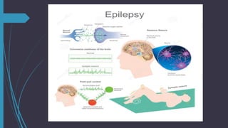 seizure / Epilepsy - Neurological Disorder | PPTX