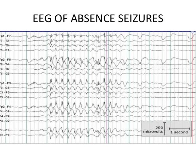 Abnormal eeg normal vs epilepsy - vametbingo