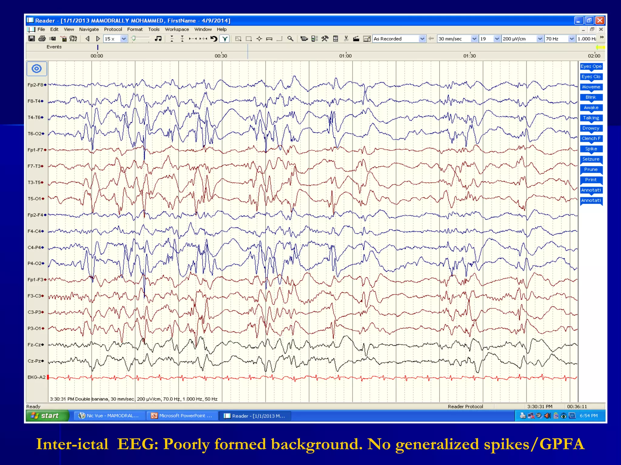 Unusual cause of Epilepsy in Children | PPT