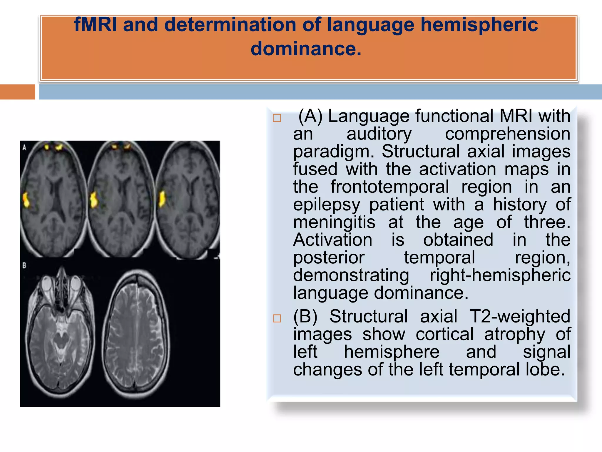 recent investigation in epilepsy | PPTX
