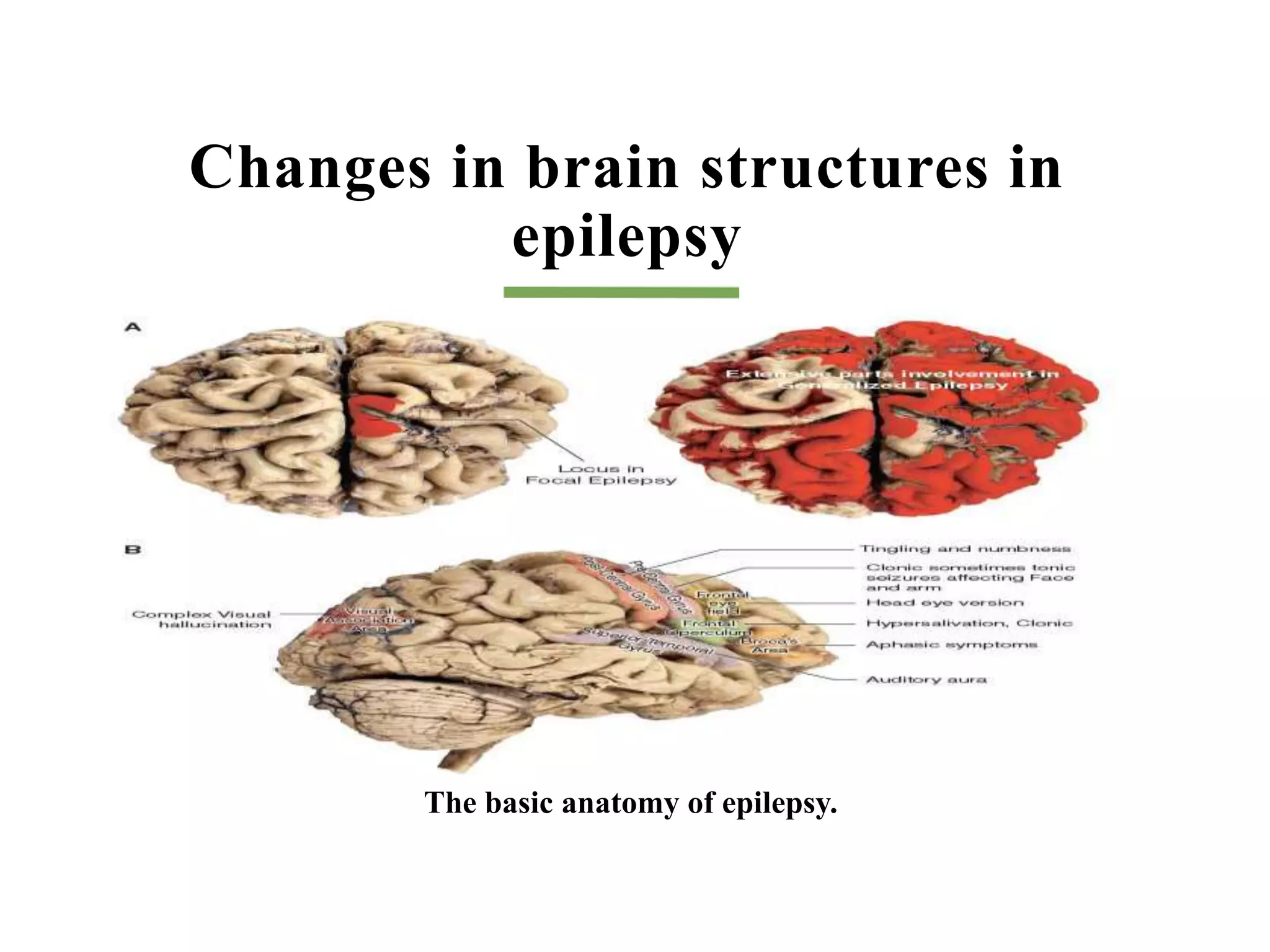 epilepsy ppt.pptx