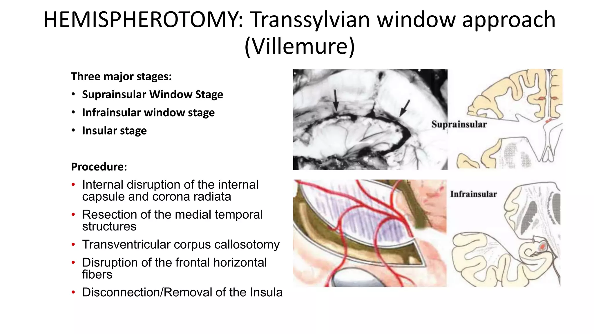 Epilepsy surgery | PPTX