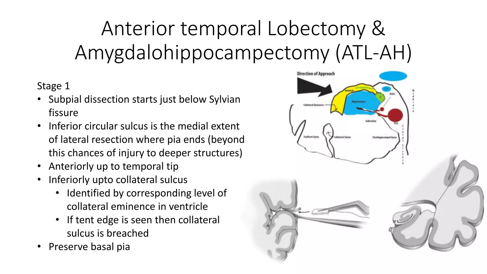 Epilepsy surgery | PPTX