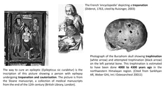 Epilepsy Surgery in Children | PPTX
