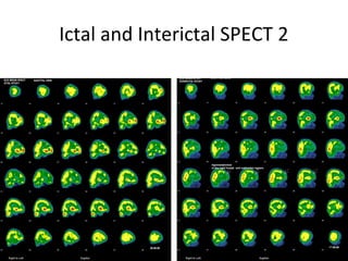 Epilepsy surgery in tuberous sclerosis, dr amit vatkar, pediatric ...