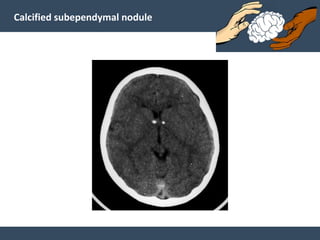 Epilepsy surgery in tuberous sclerosis, dr amit vatkar, pediatric ...