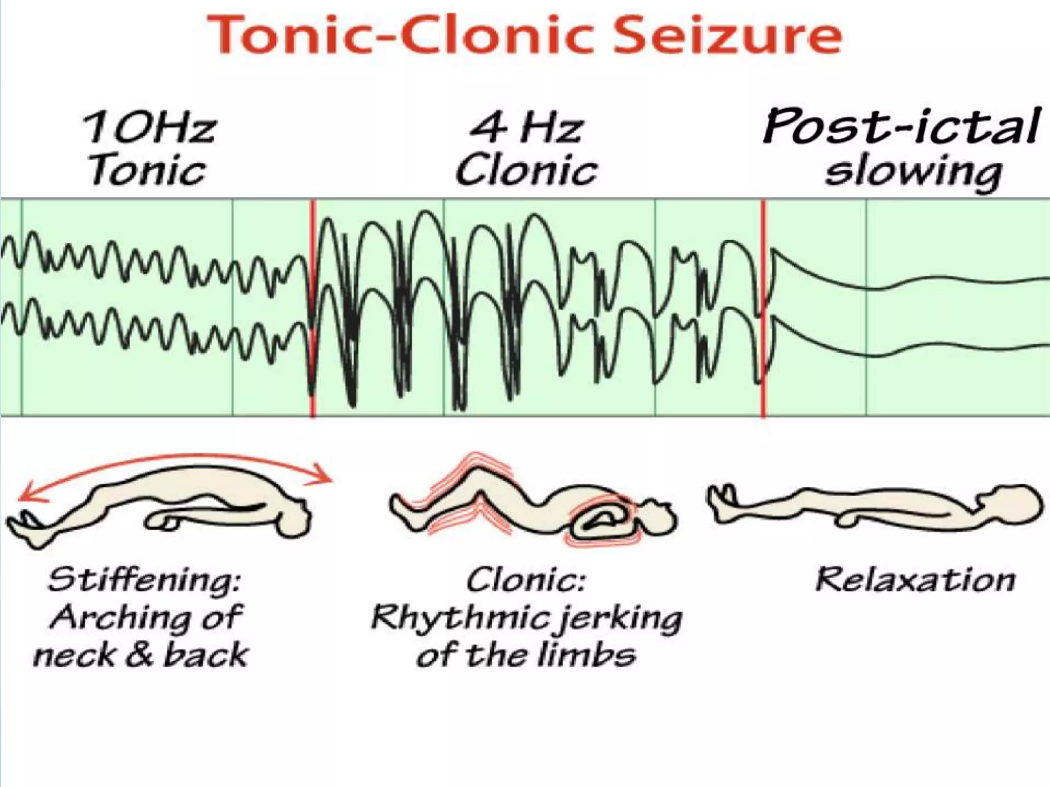 Epilepsy Types | PPTX