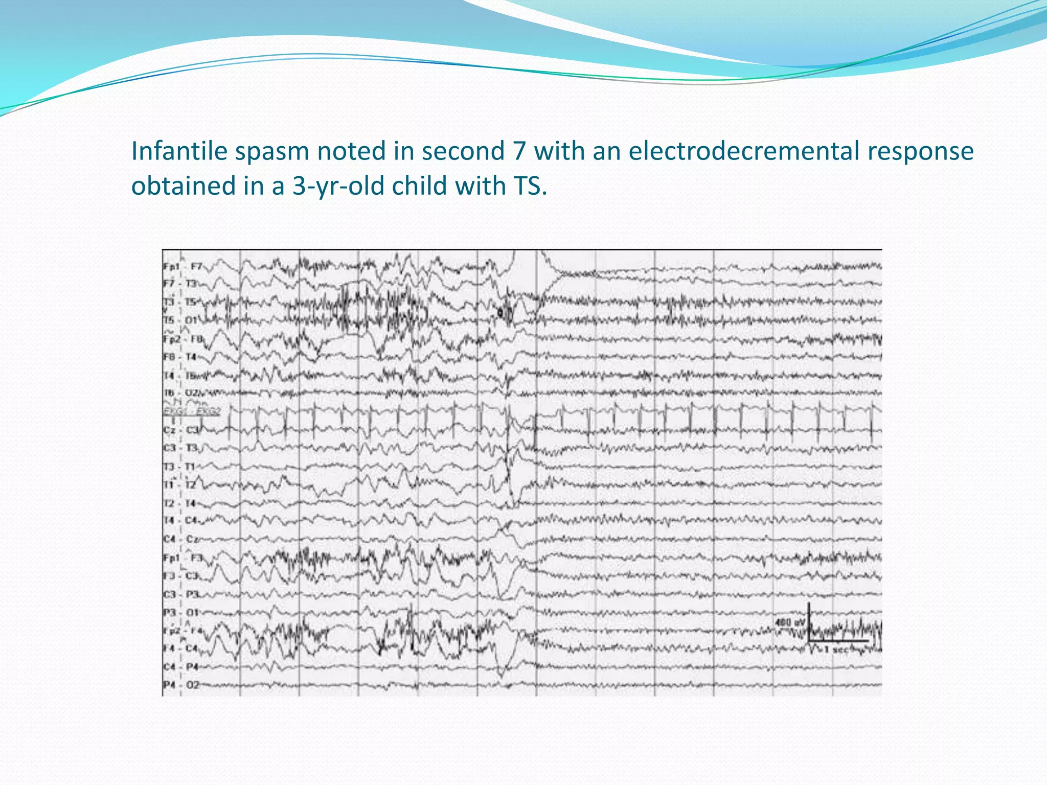 Epileptic encephalopathy -EEG | PPT