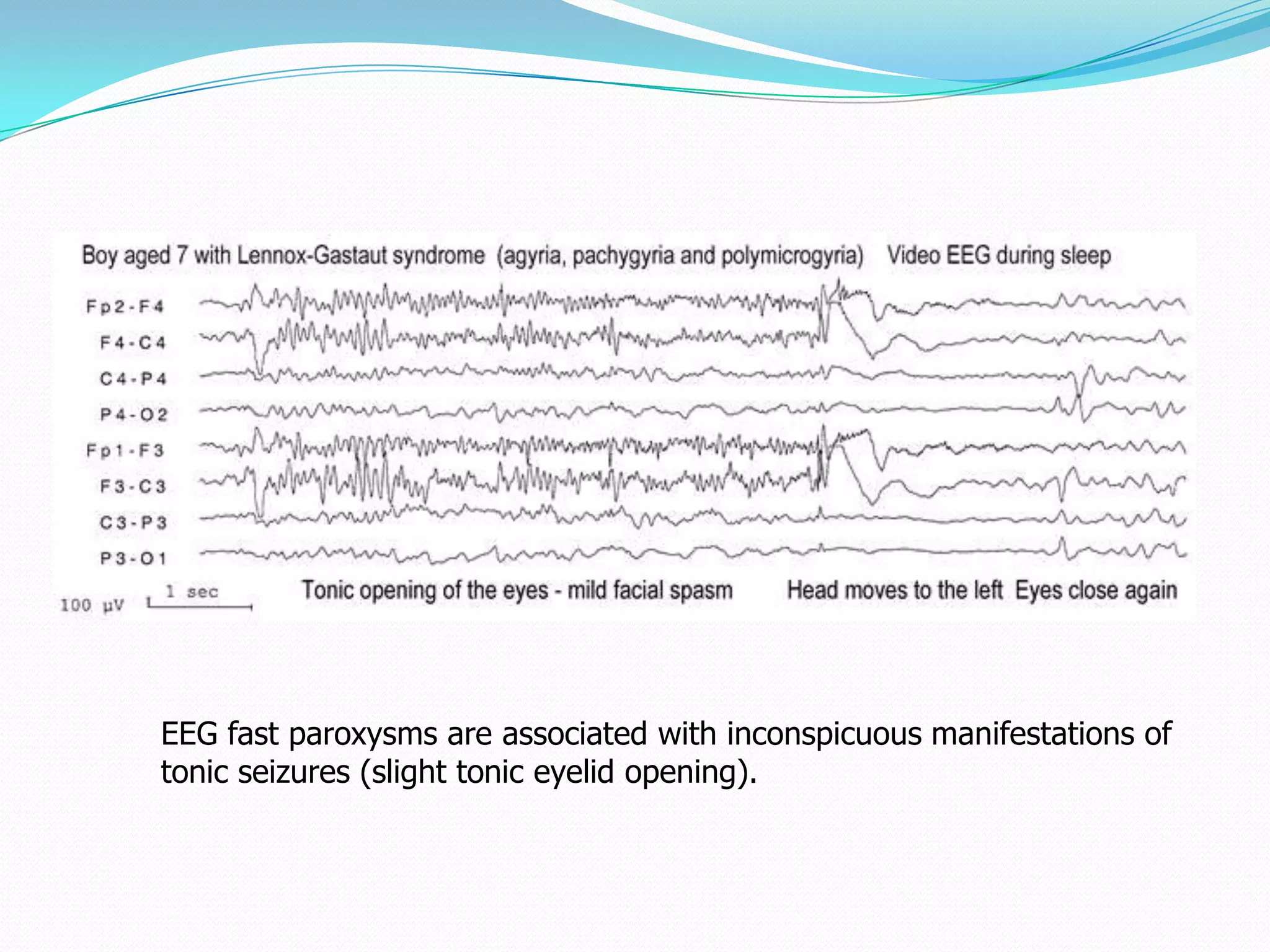 Epileptic encephalopathy -EEG | PPT